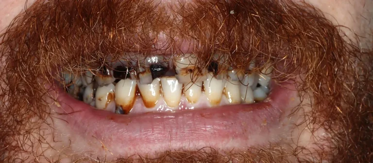Smile Gallery | Before & After Photos | Roots Dental Bellingham